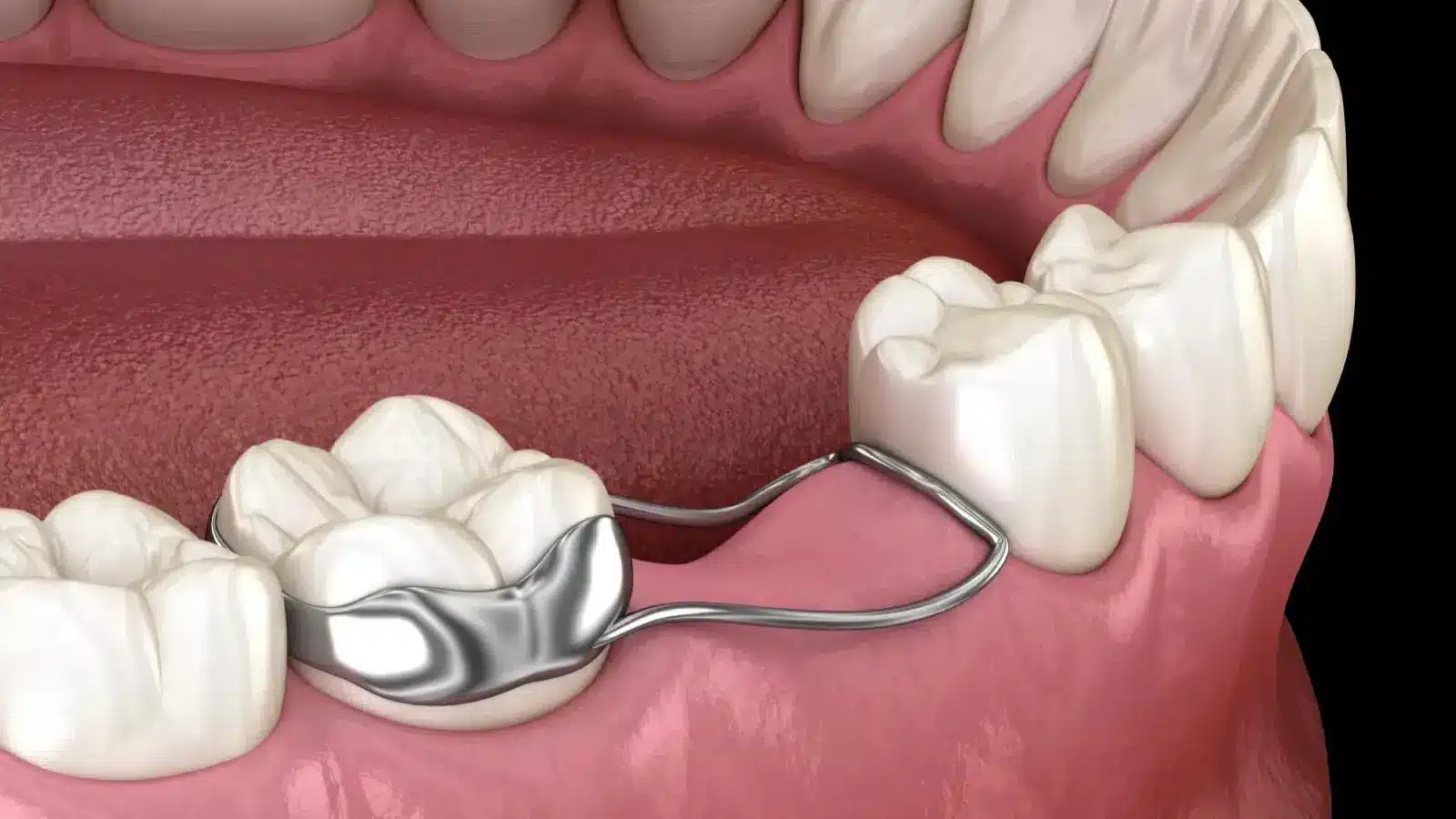 How Are Tooth Spacers Put In, And Do They Hurt? - Bubbles Dental