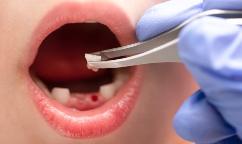 How to prepare your child for a pediatric tooth extraction?
